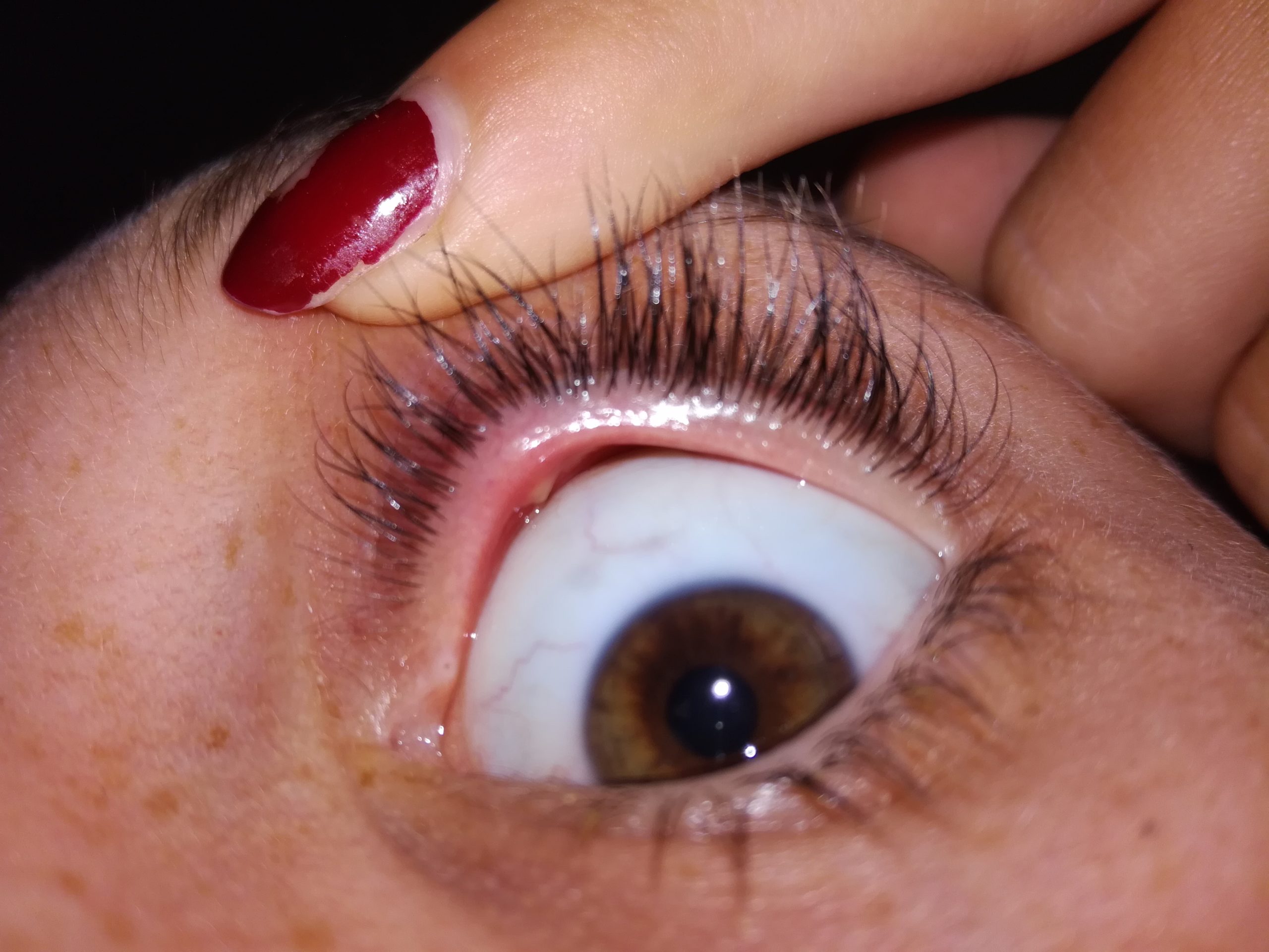 Ist ein Pickel am Auge schlimm?